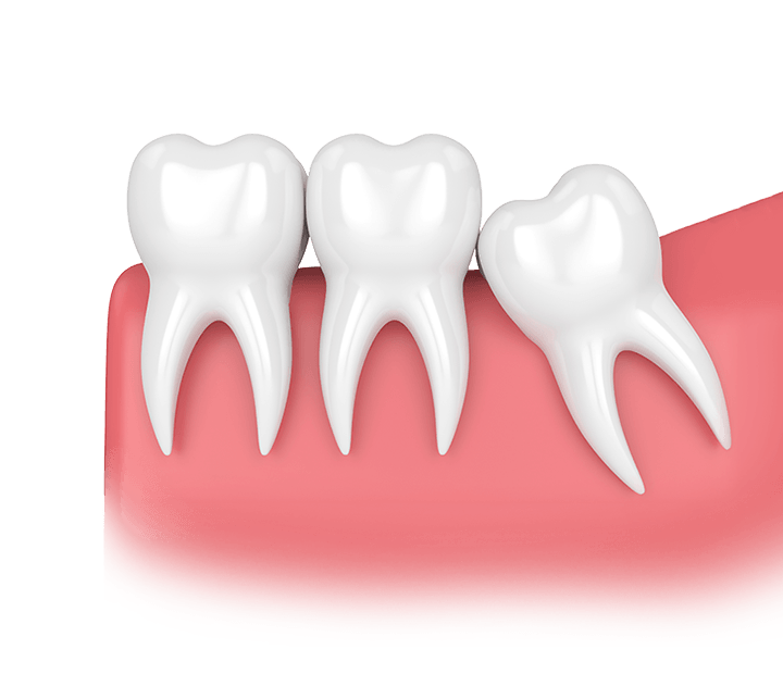 Wisdom Teeth Removal Enid, Stillwater OK | Oklahoma City Third Molars